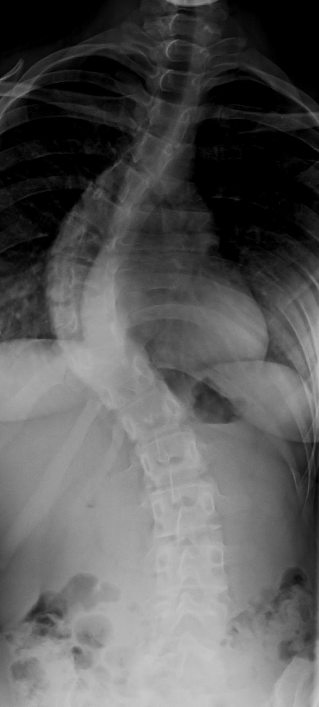 Scoliosis Tools